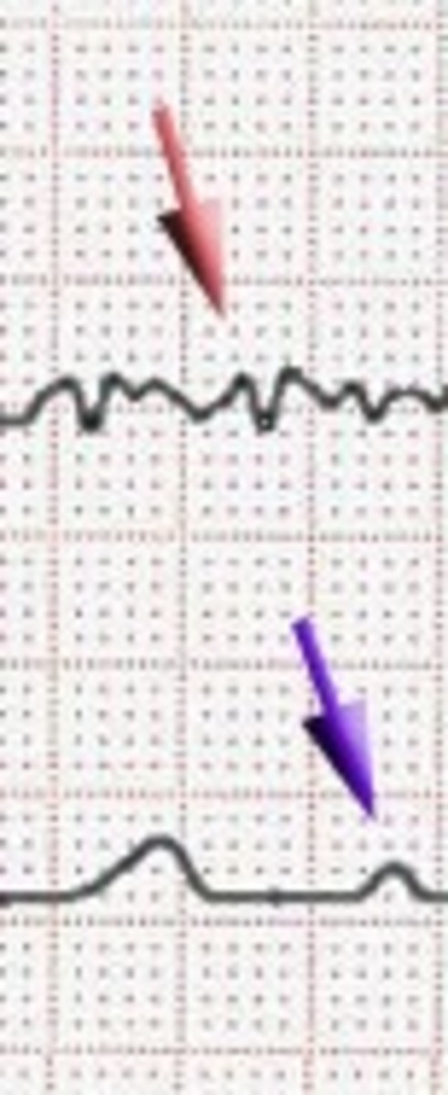 How to Read EKGs – Identifying Atrial Fibrillation - HubPages