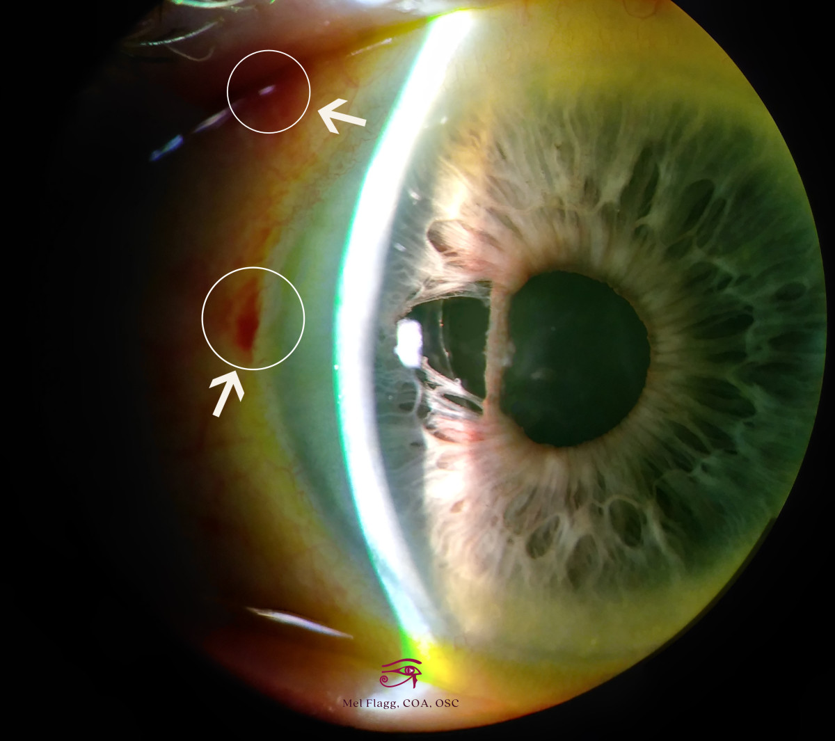 Burst Blood Vessel In Eye Sign Of Stroke - Infoupdate.org