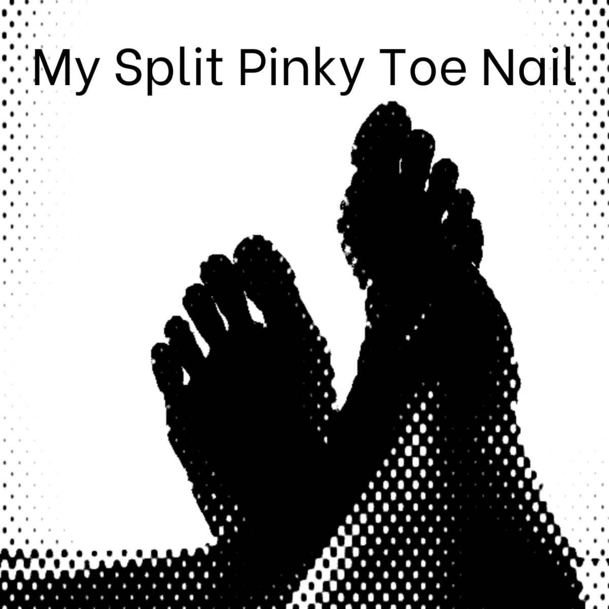 My Split Little Toenails (or Accessory Nail on the 5th Toe) - RemedyGrove
