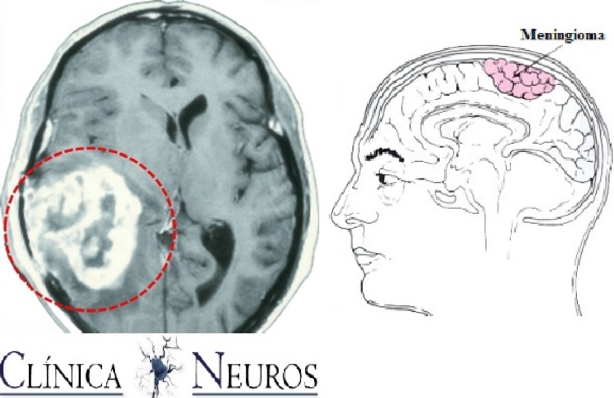 What Is Glioblastoma (GBM)? My Friend's Experience. - Patient's Lounge
