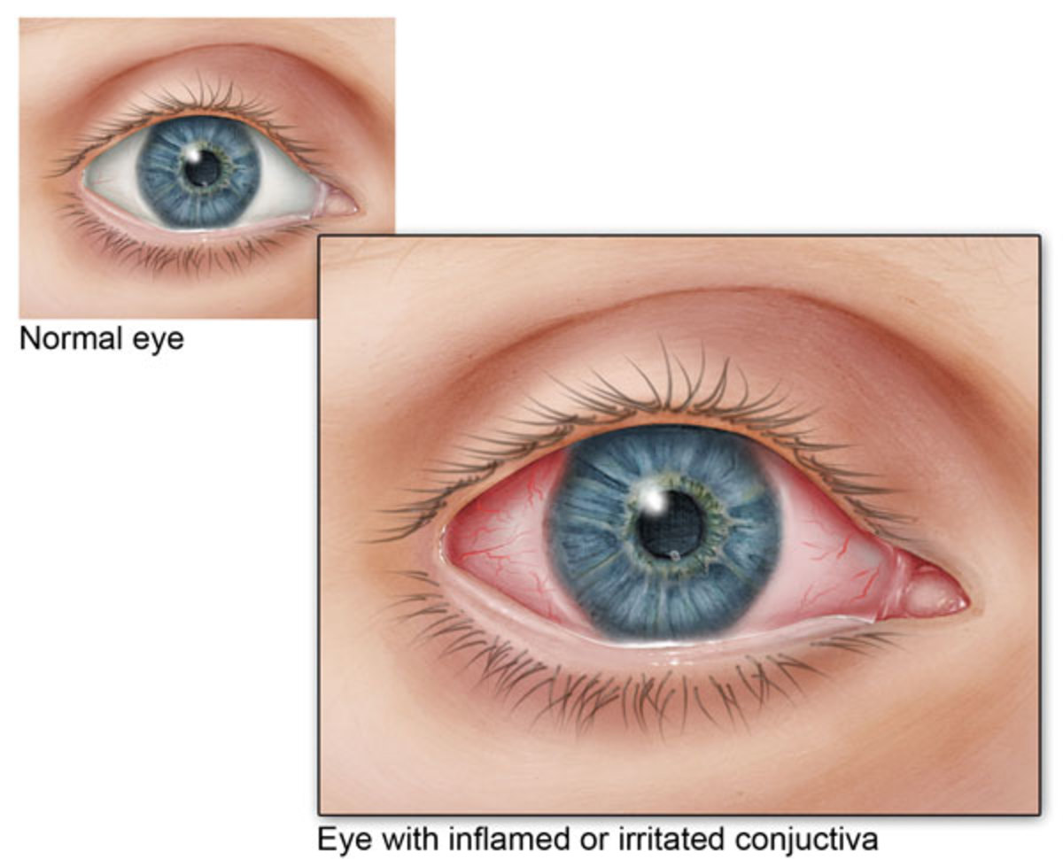 Inflammation and Allergies of the Eye - HubPages