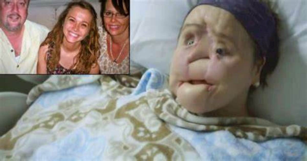 Face Transplants: Medical Miracles - HubPages