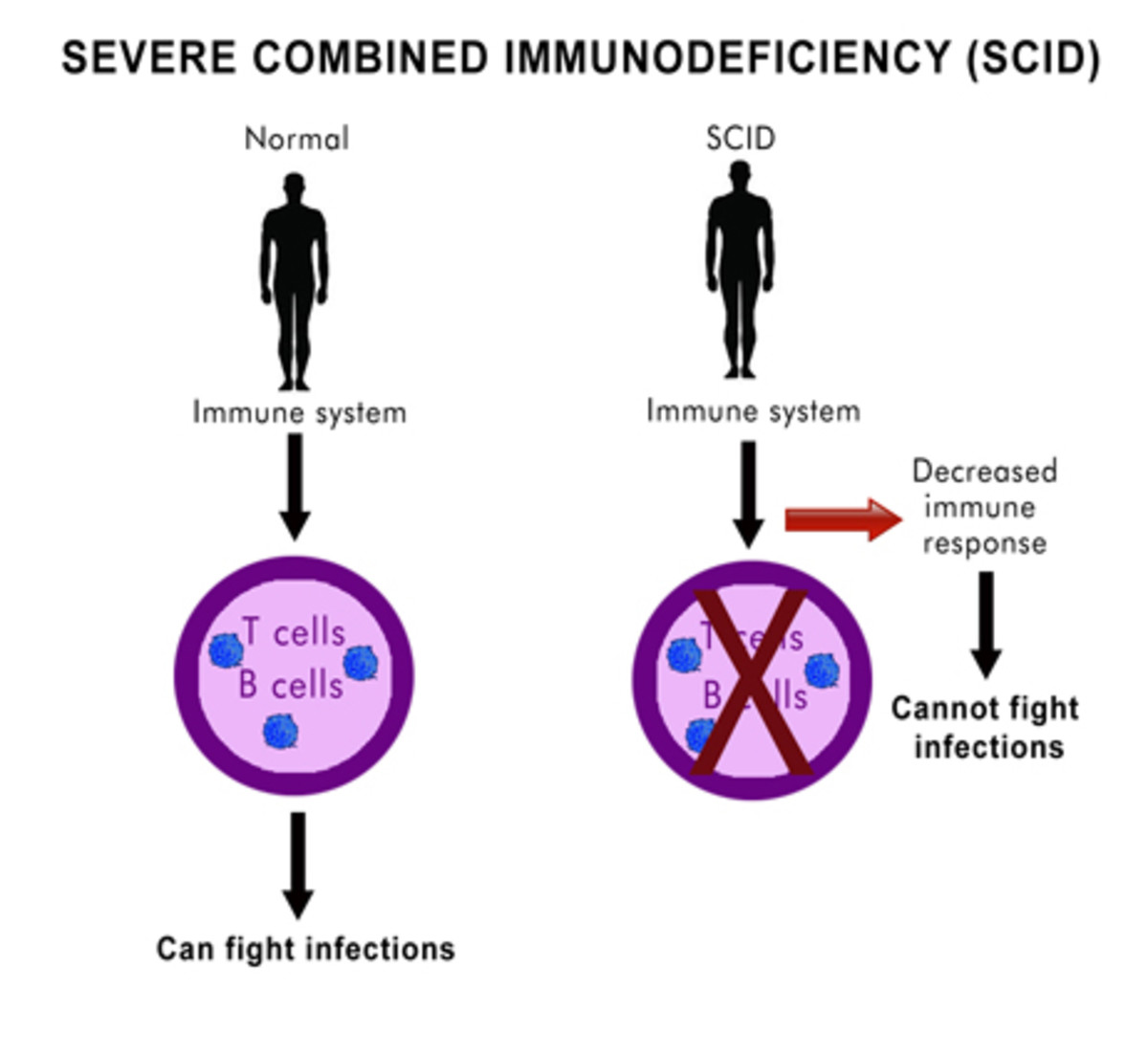 Severe Combined Immunodeficiency (SCID) - HubPages