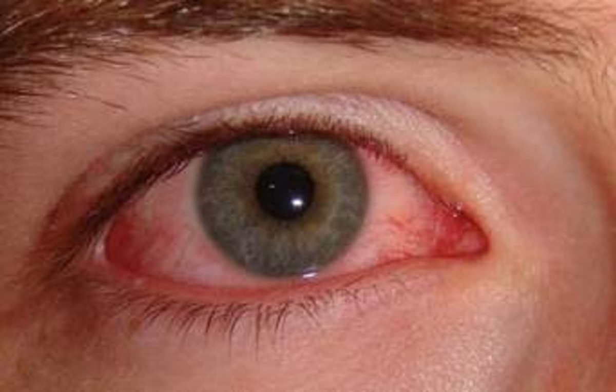 Adeno Viral Kerato Conjunctivitis - HubPages