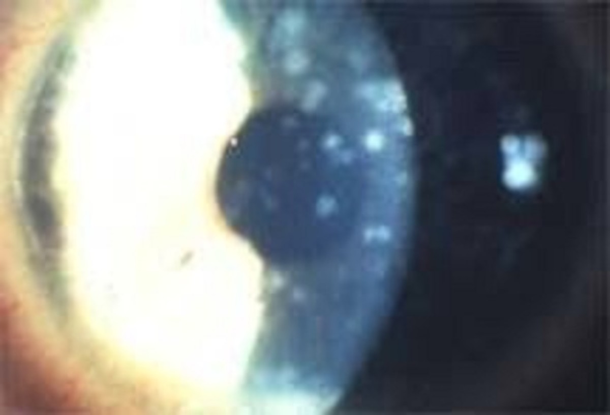 Adeno Viral Kerato Conjunctivitis - HubPages
