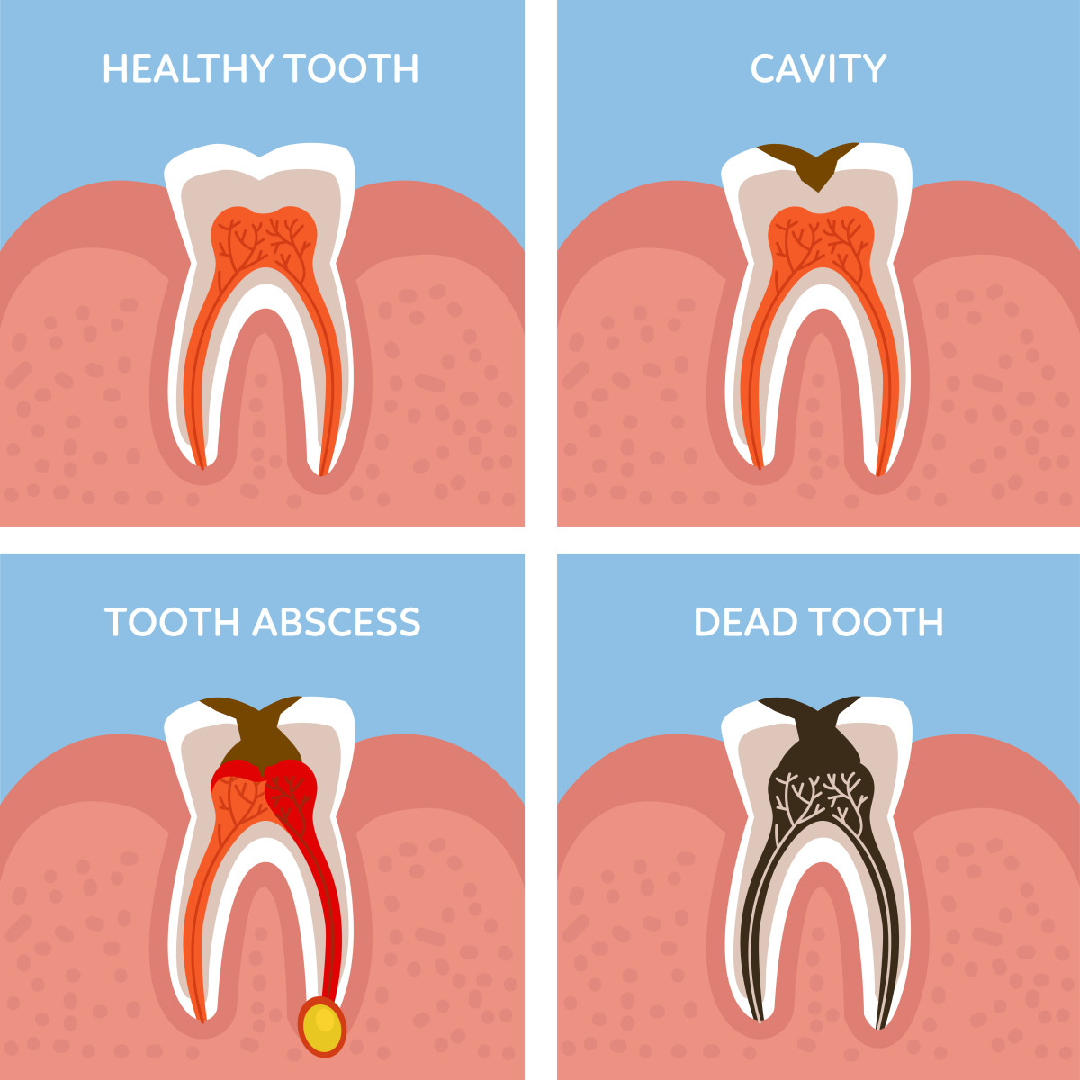 What Is a Tooth Abscess? Symptoms, Causes, and Treatment - HubPages