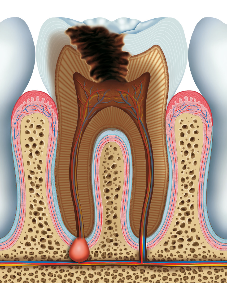 What Is a Tooth Abscess? Symptoms, Causes, and Treatment - HubPages