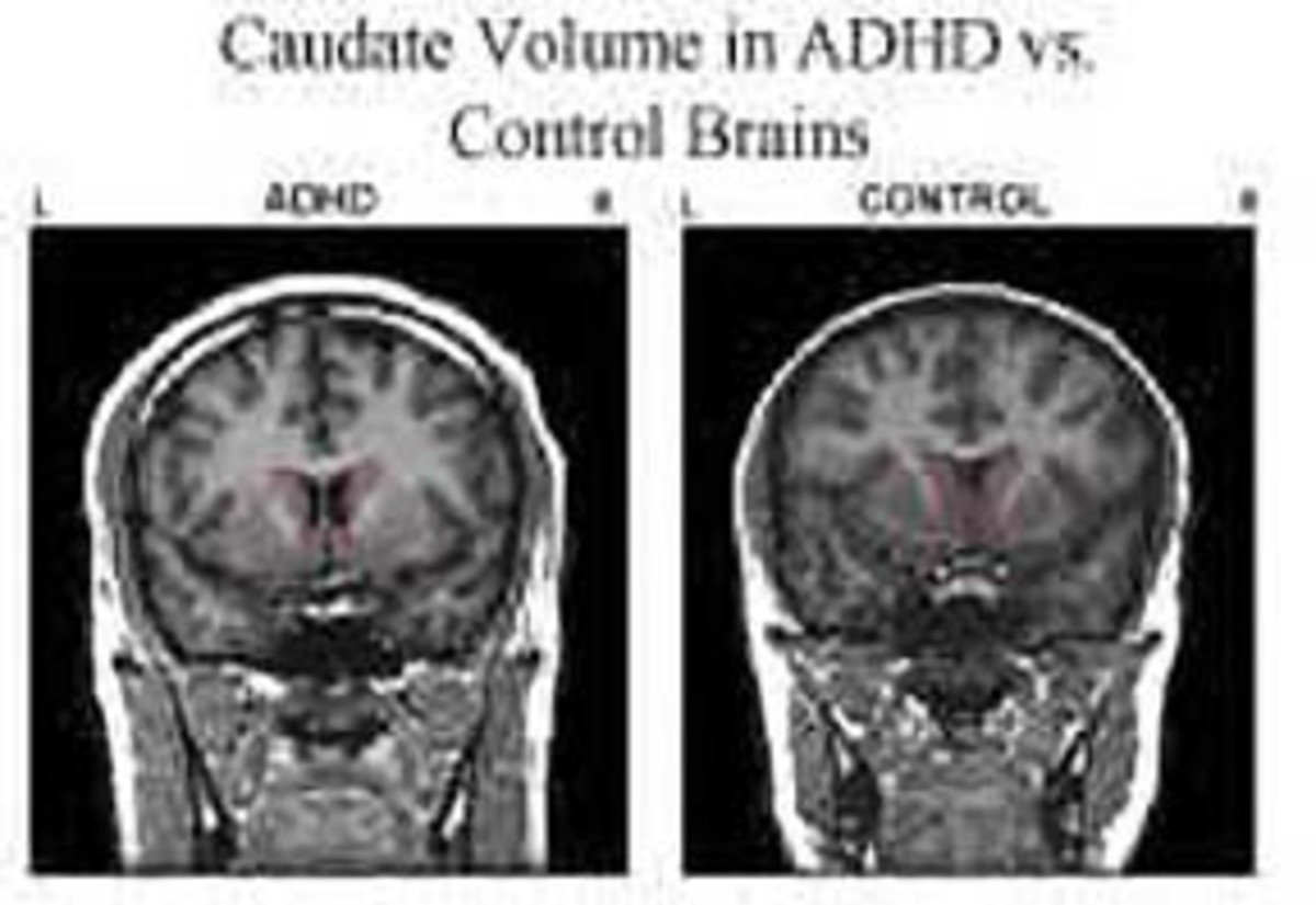 The Truth About Your Child's ADHD - HubPages