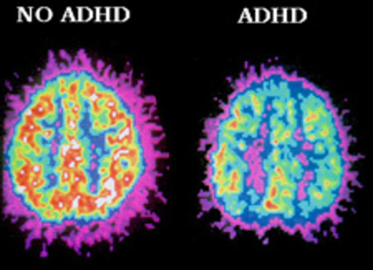 The Truth About Your Child's ADHD - HubPages